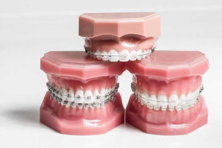 Understanding Bite Classes - Charleston Orthodontics Powered By Smile ...